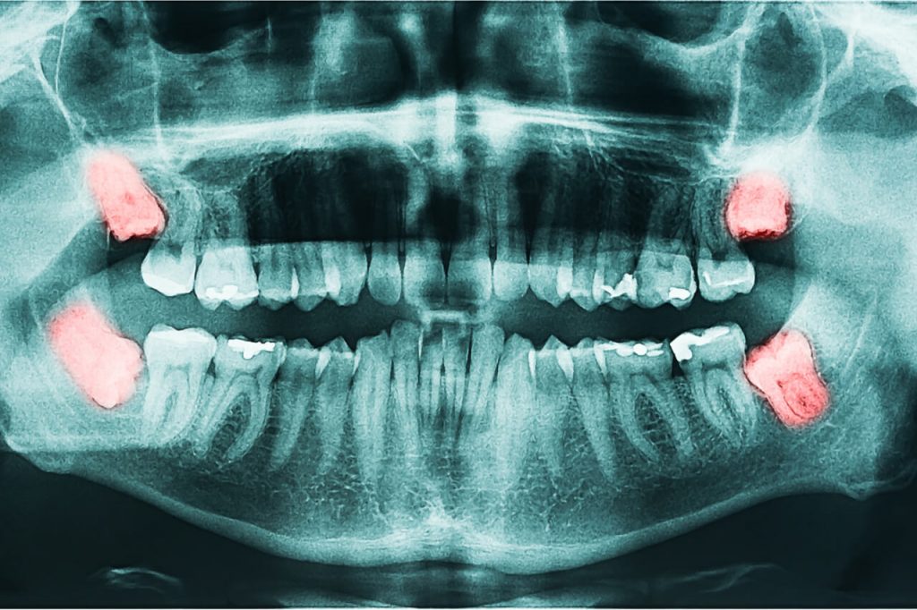 Facts about Horizontal Impacted Wisdom Teeth | ndortho.com